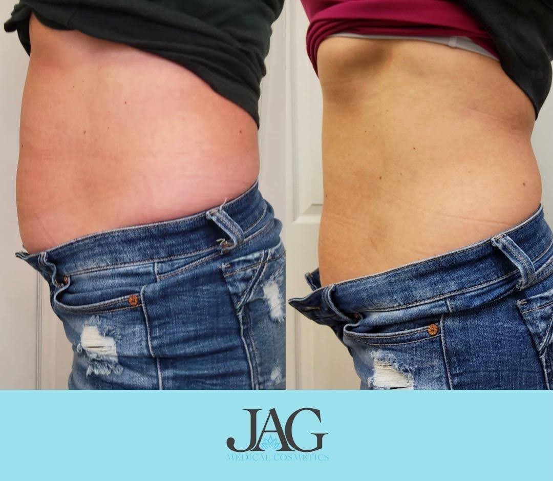 Why Emsculpt Neo Is The Best Treatment For Body Sculpting